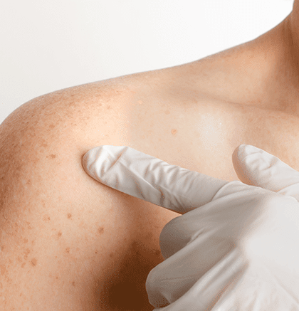 tinea versicolor back